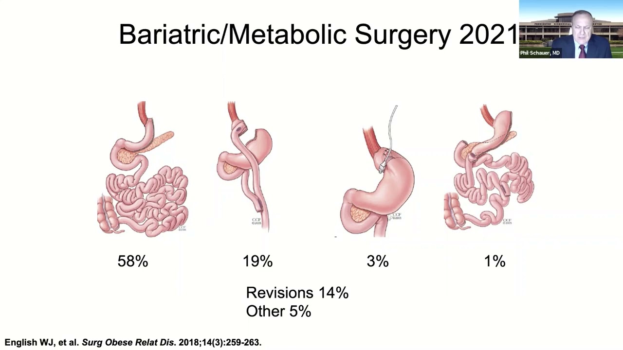 The FELLOW Project: The Evidence for Metabolic Surgery – Current Status ...