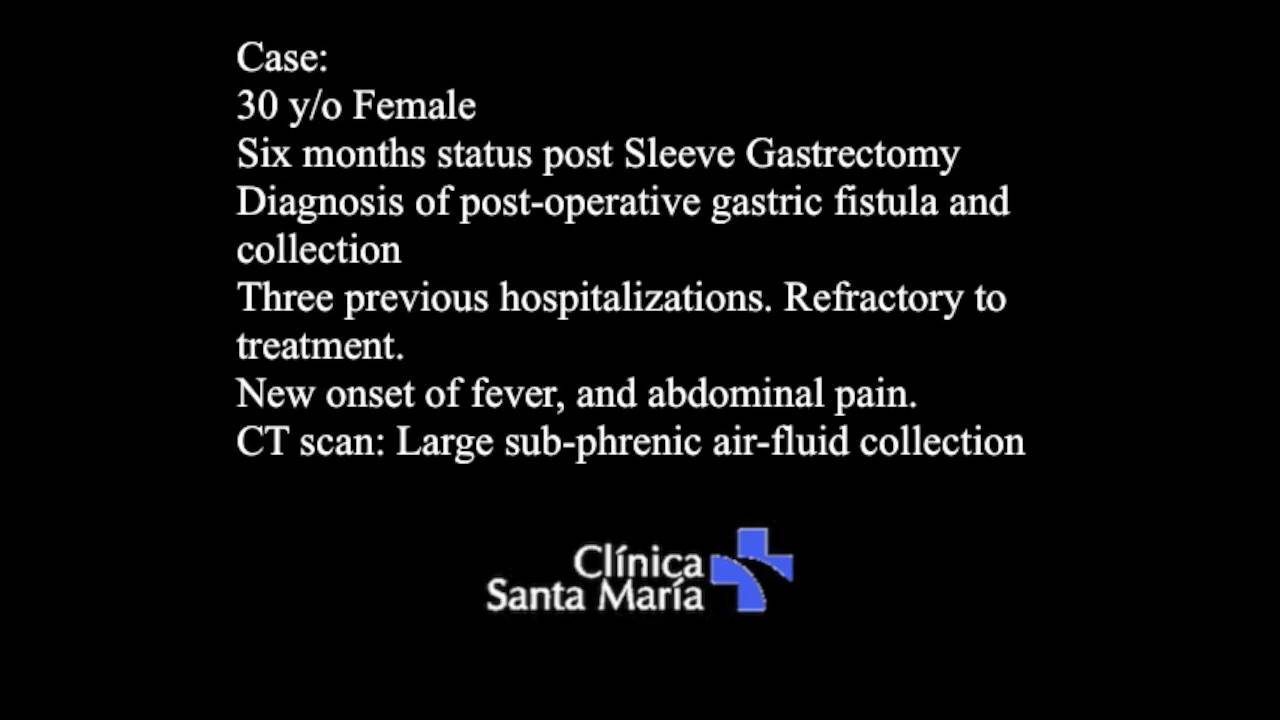 Gastrostomy tube as a novel approach for proximal staple line ...