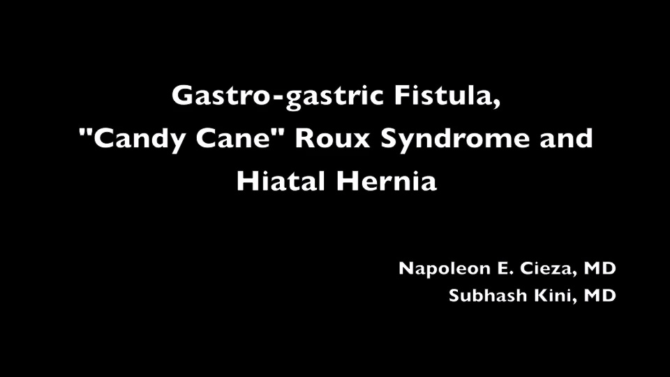 Gastro-Gastric Fistula - Candy Cane Roux Syndrome and Hiatal Hernia ...