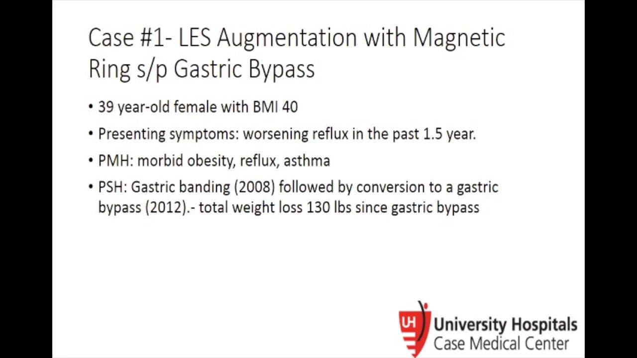 A novel approach to reflux after bariatric surgery - American Society ...