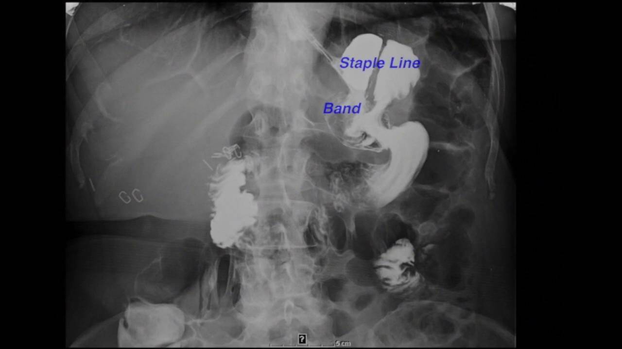 Laparoscopic reversal of vertical banded gastroplasty - American ...