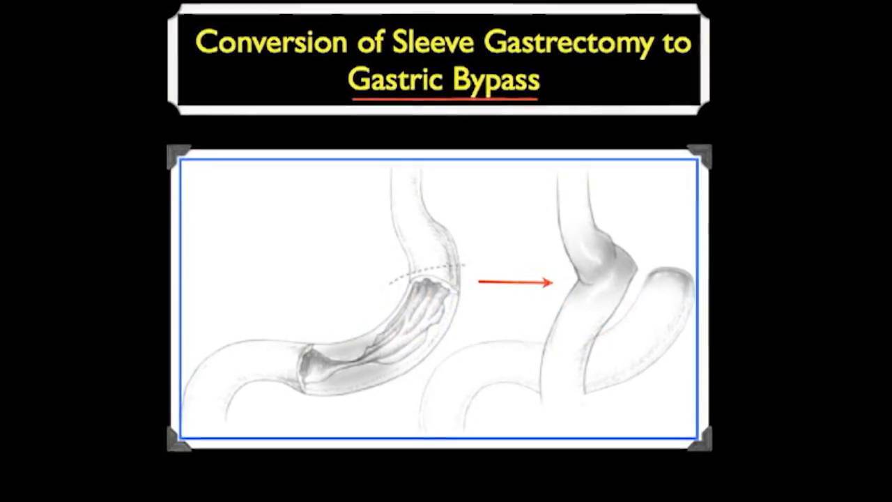 Conversion of failed laparoscopic adjustable gastric banding (lagb) to ...