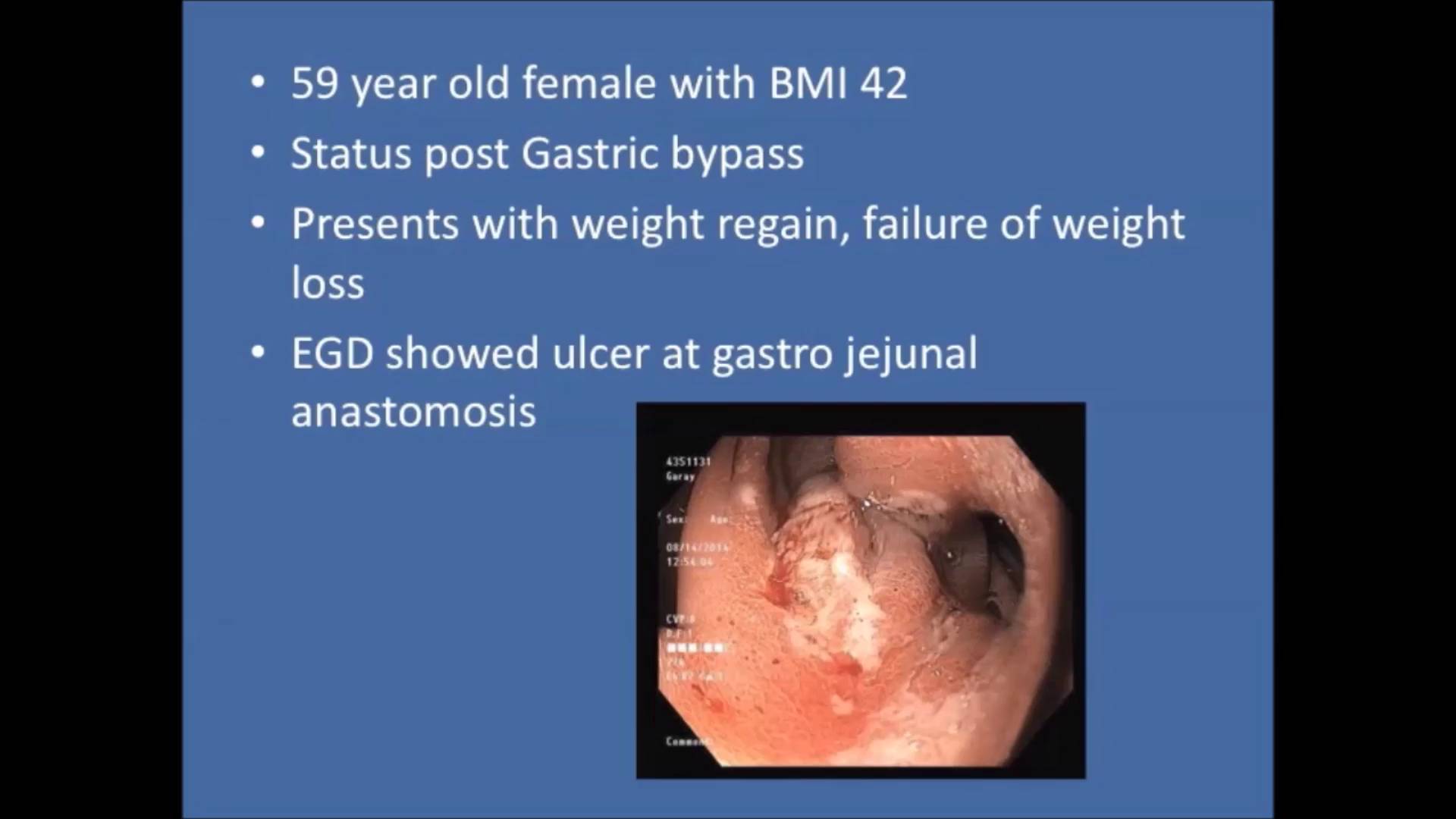 Laparoscopic management of GJ-remnant fistula after gastric bypass ...