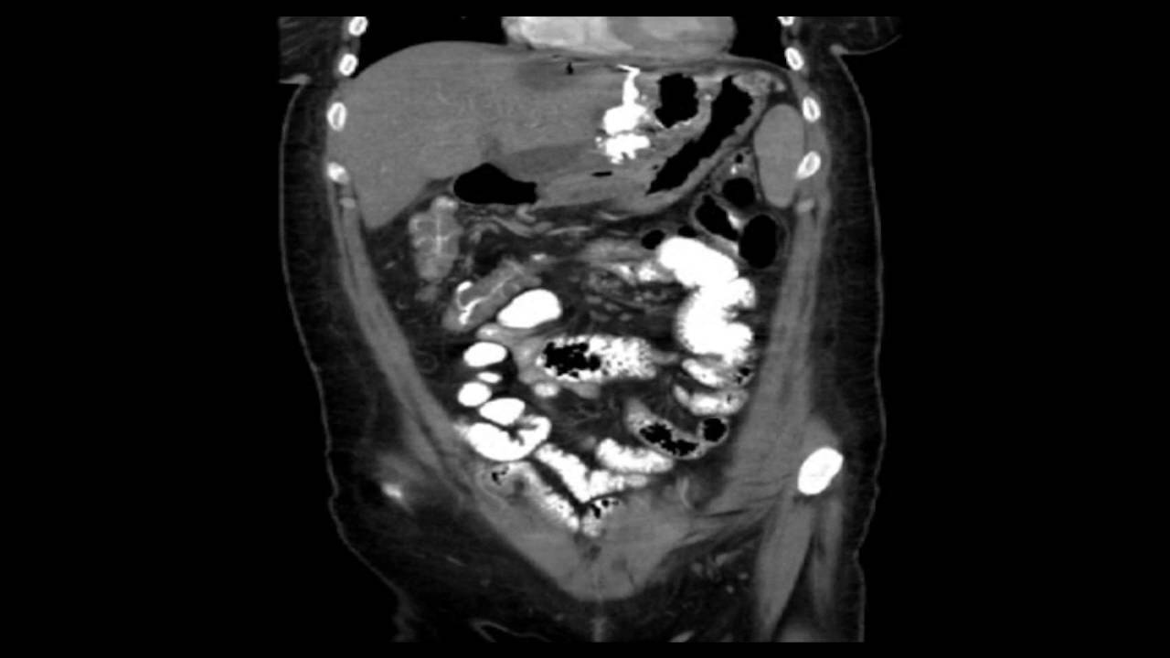 Reversal of gastric bypass for the acute treatment of a giant ...