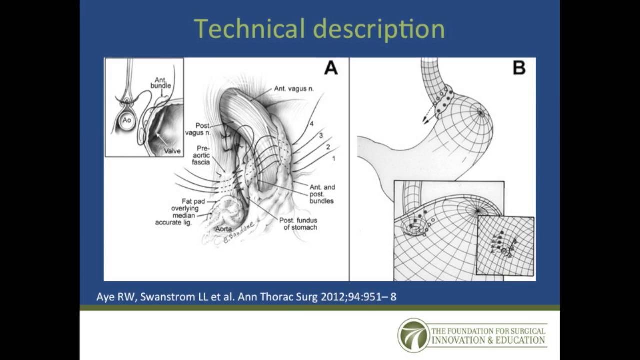 Hill procedure for recurrent gastroesophageal reflux post roux-en-y ...