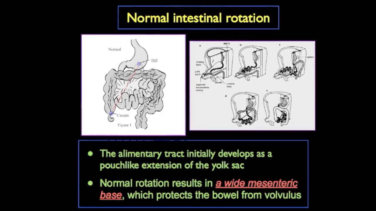 Laparoscopic roux en y gastric bypass (lrygb) in a known case of midgut ...