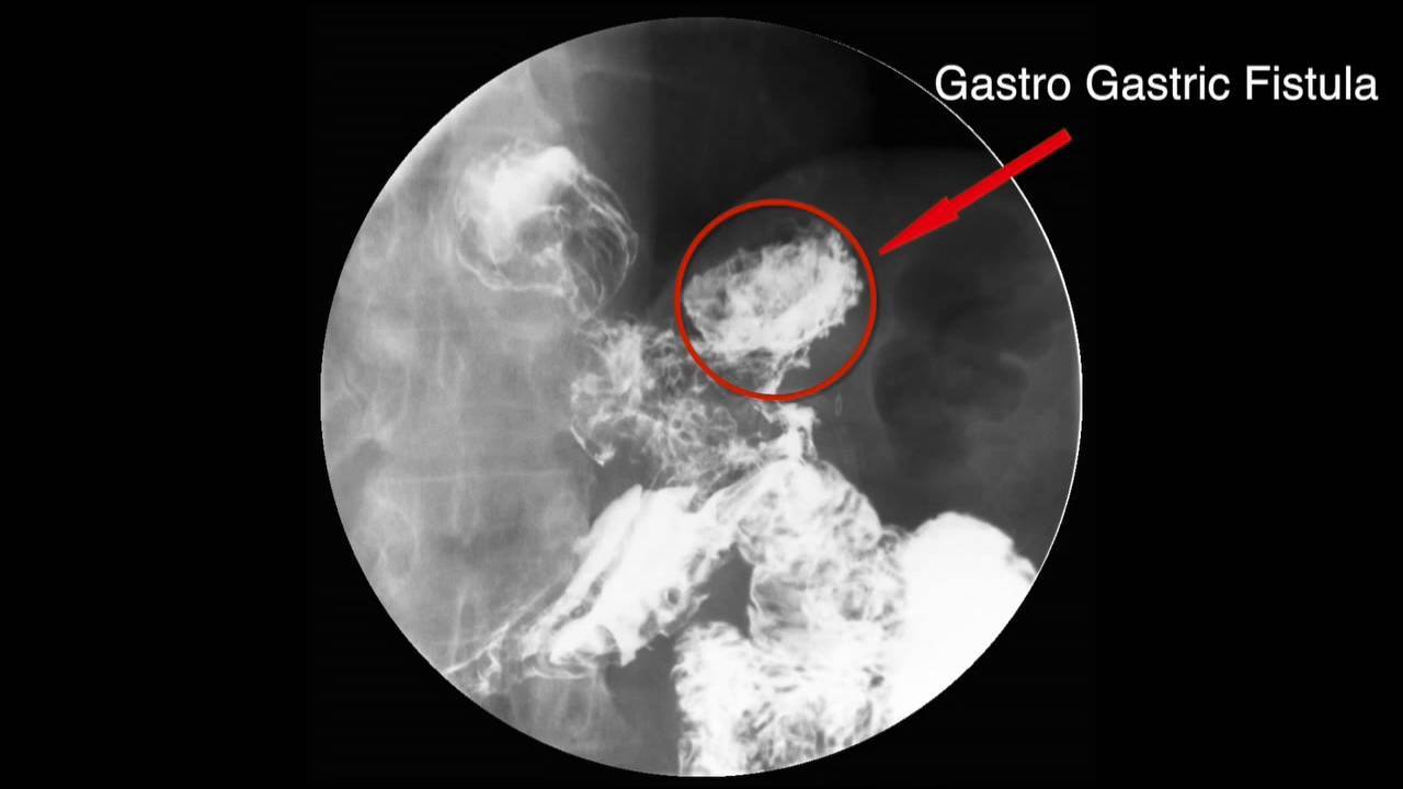 Endoluminal closure of gastro-gastric fistula - American Society for ...